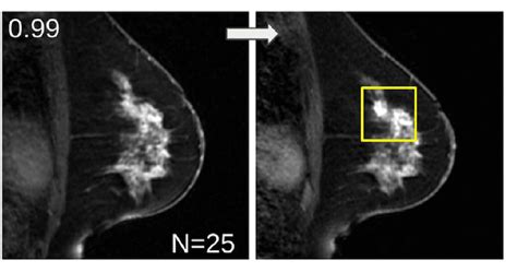 can an emerging ai model enhance early breast cancer detection on mri