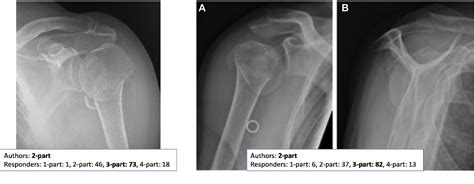 Figure 4 From The Reliability Of The Neer Classification For Proximal