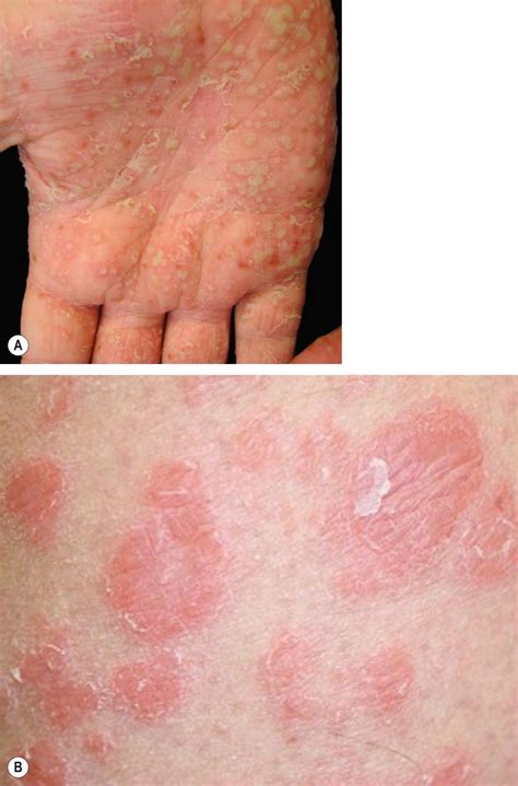 Systemic Immunomodulators Clinical Tree
