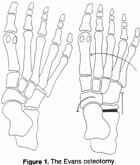 Talipes Calcaneovalgus Semantic Scholar
