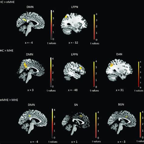 Differences Among Groups In The Resting State Functional Connectivity