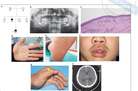Figure 1 From Novel Ptch1 Mutation Causes Gorlin Goltz Syndrome Semantic Scholar