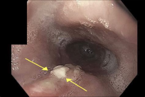 Isotretinoin Induced Pill Esophagitis Pmc