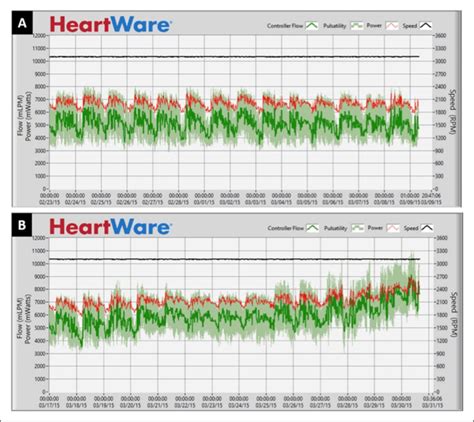 LVAD Parameters And Flow Pulsatility Displayed Over Days LVAD Data Download Scientific