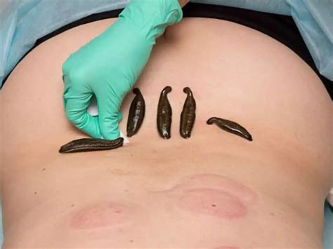 Leech Therapy Safety Revealed At Healing Academy