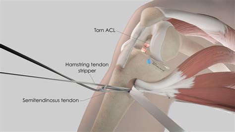 Hamstring Tendon Acl Anterior Cruciate Ligament Reconstruction Is
