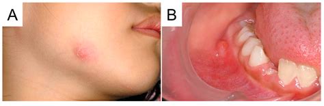 Dentoalveolar Abscess Caused By Pericoronitis Of An Erupting First Molar
