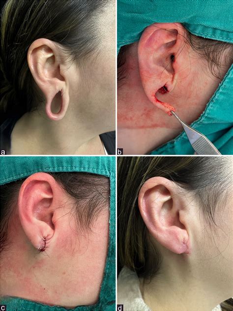 Esthetic And Reconstructive Options For Earlobe Deformities Jcas