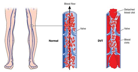 Arterial Thrombosis Vs Venous Thrombosis
