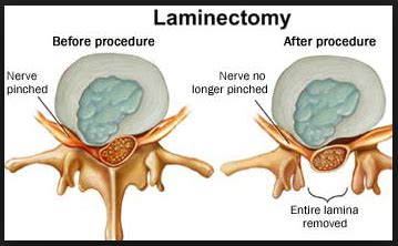 Lumbar Decompression