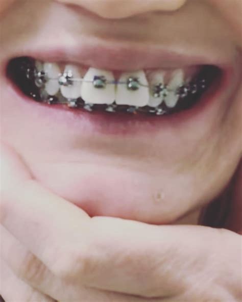 Braces Are Finally Off Rbraces