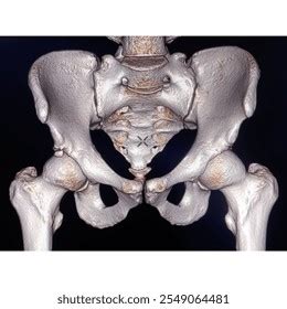 Ct Scan Pelvic Bones Both Hip Stock Photo 2549064477 Shutterstock