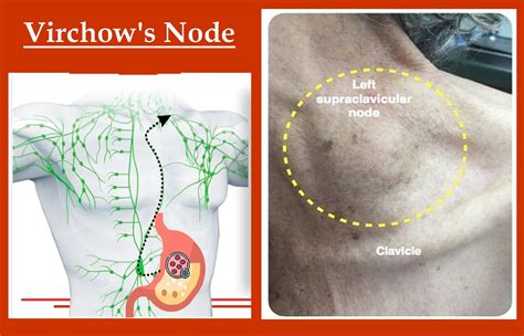 Virchows Node Is A Lymph Node Dr Fernando Venegas Md Facebook