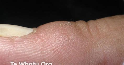 Digital Myxoid Cyst Image