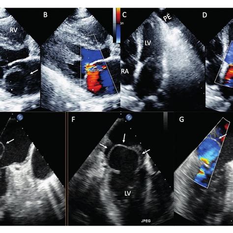 Transthoracic 2d Doppler Echocardiography In The Parasternal Long Axis