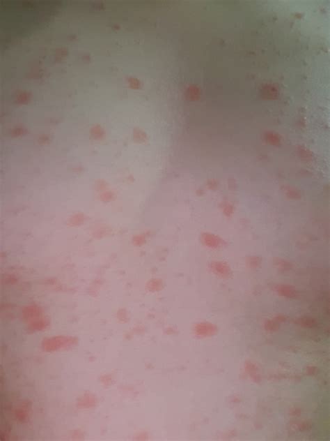 바이러스성 피부발진 지식in