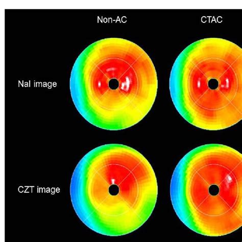 PDF Cardiac SPECT CT Imaging CT Attenuation Correction And SPECT CT Hybrid Imaging