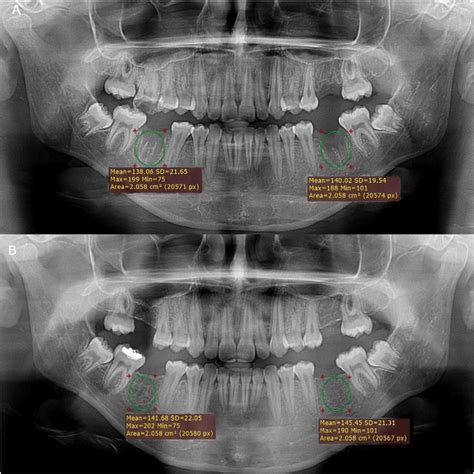 A Soft Tissue Healing At Extraction Socket With The Platelet Rich Download Scientific Diagram