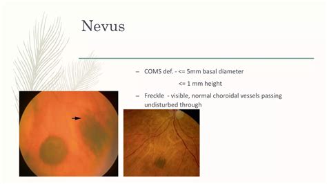 Choroidal Nevus And Chrpe Pptx