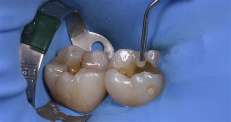 Amalgam Replacement With Flowable Composite Case Study