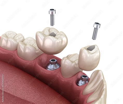 Premolar And Molar Tooth Crown Installation Over Implant Screw