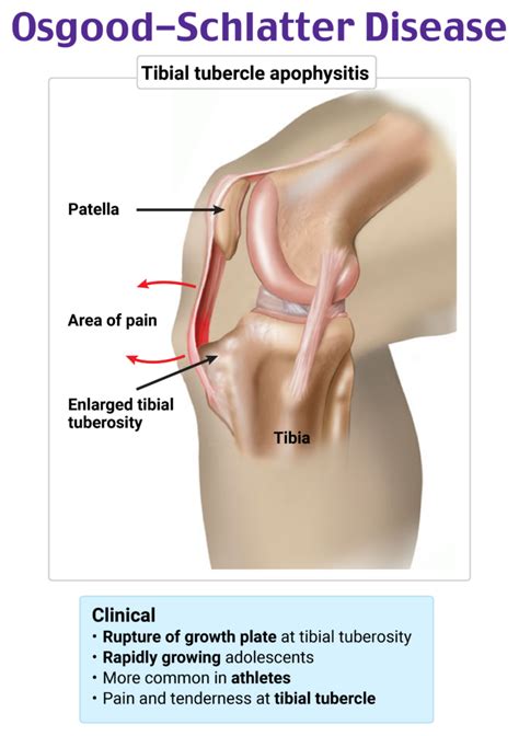 Tibial Tubercle Palpation