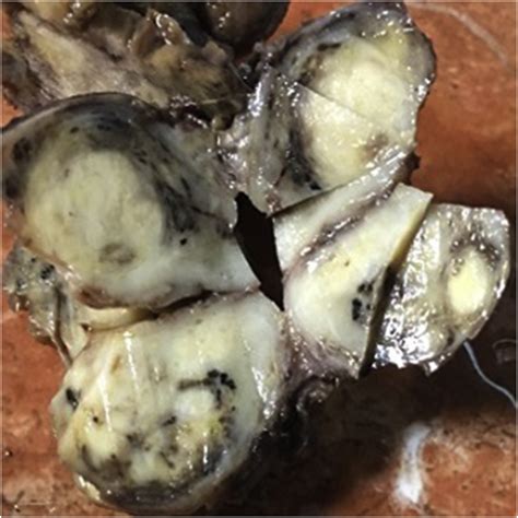 Peripheral Primitive Neuroectodermal Tumor Associated With Paraneoplastic Cushings Syndrome