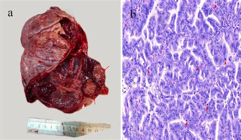 A Gross Examination The Ovarian Mass Measured 15 × 9 × 4 Cm With A