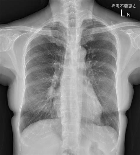 無菸酒史竟罹肺癌！40歲男體檢驚見「5公分腫瘤」 醫：這群人要小心 祝你健康 三立新聞網 Healthsetncom