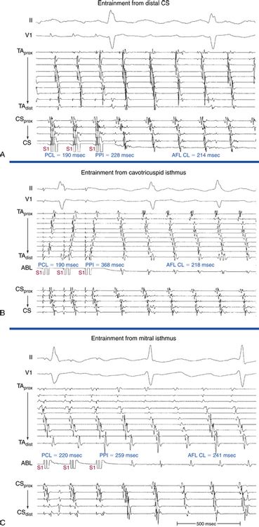 Macroreentrant Atrial Tachycardia “atypical Atrial Flutter” Musculoskeletal Key