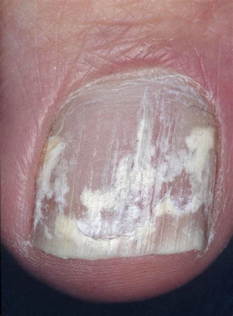 White Superficial Onychomycosis Nail Fungus At Betty Coleman Blog
