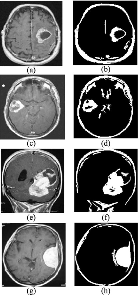 Figure 4 From Mri Brain Tumor Detection Methods Using Contourlet