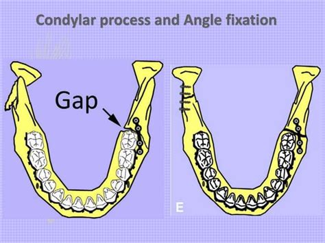 Open Reduction And Internal Fixation Of Combined Angle And Body