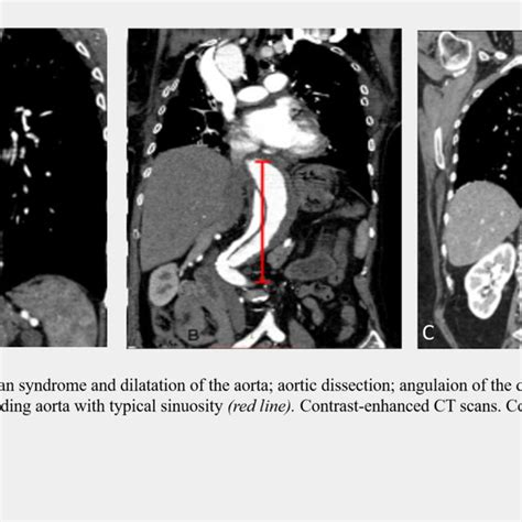 Svenson Classification Of Aortic Dissection Download Scientific Diagram