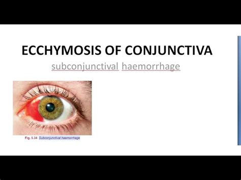 Ecchymosis Eye