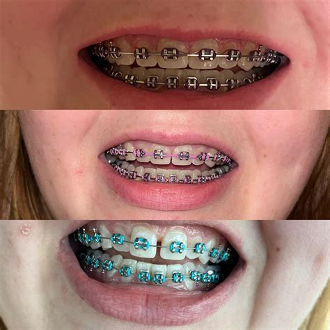 6 Months With Braces R Braces