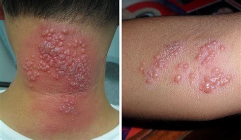 Все про герпес на тілі і його лікуванні | MedPrice.com.ua