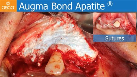 2 Phase Total Maxillary Rehabilitation With Bone Reconstruction And An All On 6 Augma Biomaterials