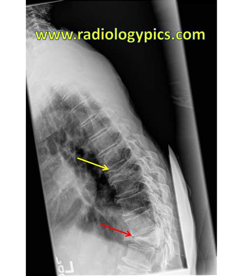 Thoracic Spine Compression Fractures Vertebra Plana Radiologypics