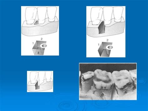 Bone Loss And Patterns Of Bone Lossppt1
