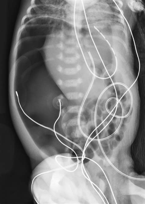 Spontaneous Intestinal Perforation Applied Radiology