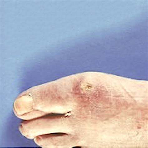 What Is Scleroderma Symptoms And Treatment In Australia Sydney