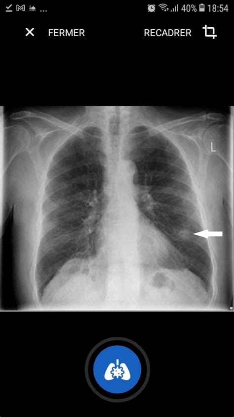 Artificial Intelligence App Locate Pulmonary Nodule And Help Doctors Detect Early Stages Of Lung