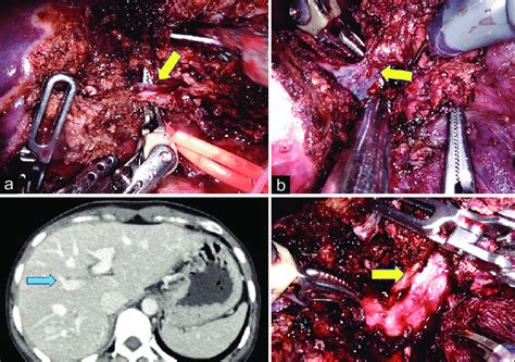 Segment Ivb And V Liver Resection A Dissection Of The Branch Arrow