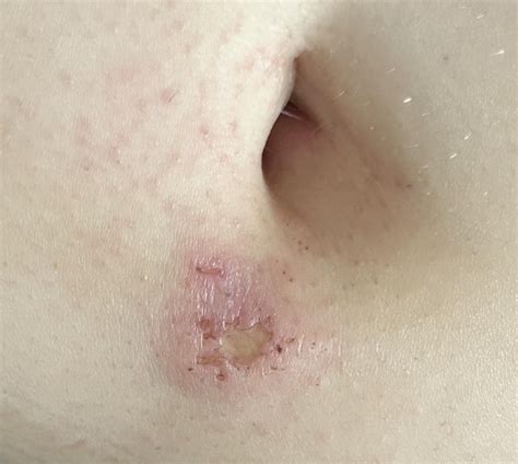 Nsfw Crater Scar Hyperpigmentation On Stomach Pls Help R