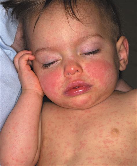 Adverse Reaction To Mmr Immunization Consultant360