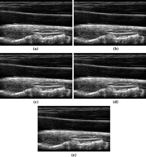 A Ultrasound Image Of Common Carotid Artery Carotid 1 Despeckling Download Scientific