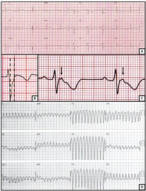 Arrhythmogenic Cardiomyopathies Acs Diagnosis Risk Stratification And Management Heart