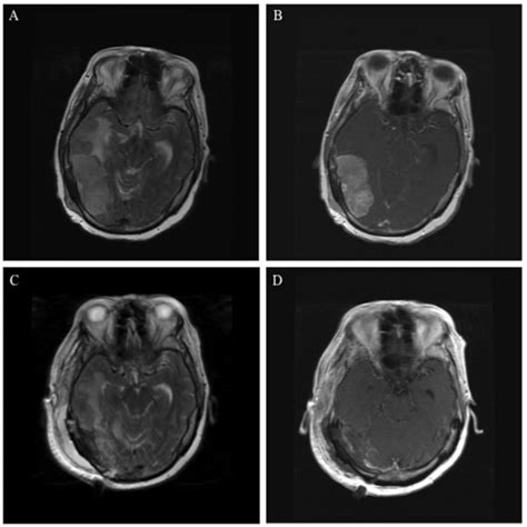 Resection Of Dural Based Brain Metastasis Pre And Postoperative Mri