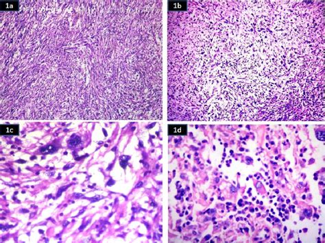 A Hypercellular Spindle Cell Area Hande X100 B Hypocellular Bizarre Download Scientific Diagram